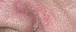 Why I Have Dry Flaky Skin Around Nose and Corners of Mouth | iythealth.com