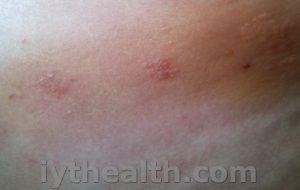 Lichen Striatus: Symptoms, Causes and Treatment