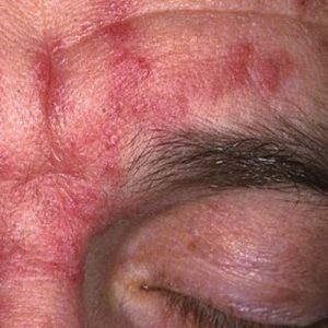 How to Treat Seborrheic Dermatitis at Home - Health Advisor