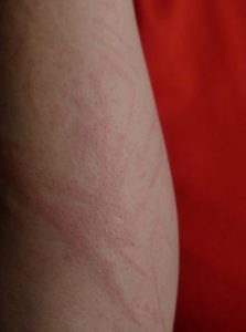 How Do I Know If I have Latex Allergy - Health Advisor