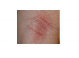Asp Sting: Signs and Treatment - Health Advisor