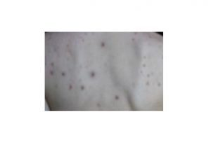 Brown Spot on Chest - Health Advisor