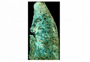 Mild Bibasilar Atelectasis: 6 Reasons Why You’re at Risk - Health and ...