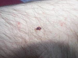 How to Get Rid of Red Freckles? - Health Advisor