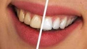 How to Get Rid of Calcium Deposits on Teeth? - Health Advisor