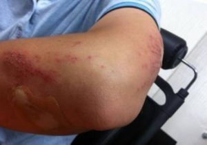 What is a Laceration Injury? - Health Advisor