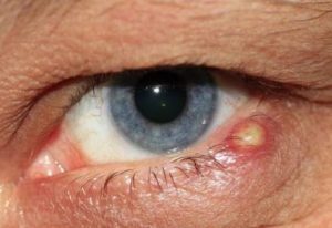 Cyst on White of Eye - Health Advisor