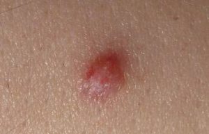 Tiny Red Dots on Skin - Health Advisor