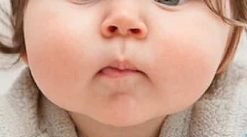 Big Fat Cheeks: How to Remove Them - Health Advisor