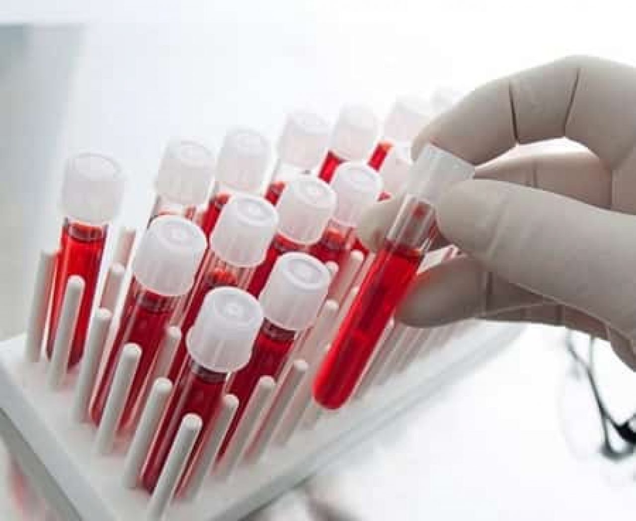 Meaning of High and Low ESR Count In Blood Test - Health Advisor