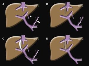 How Long Can You Live After a TIPS Procedure? - Health Advisor