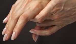What Causes Swollen Finger Joints? - Health Advisor