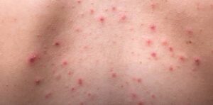 Acne on the Back: Causes, Signs, Treatment and Prevention