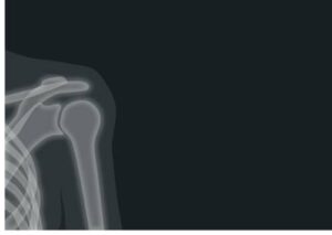Pain in the Collarbone - Health and Home