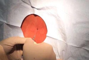 What is the difference between a medical LP and a biopsy - Health Advisor